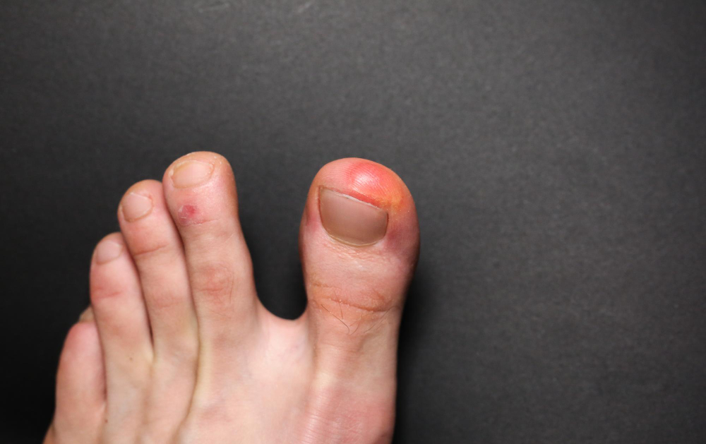 How to Prevent a Wound From Becoming Infected | Trinity Salem Family Health